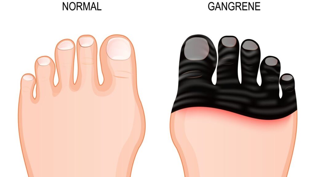 Gangrene Treatment in Hyderabad | Limb Salvage & Wound Care